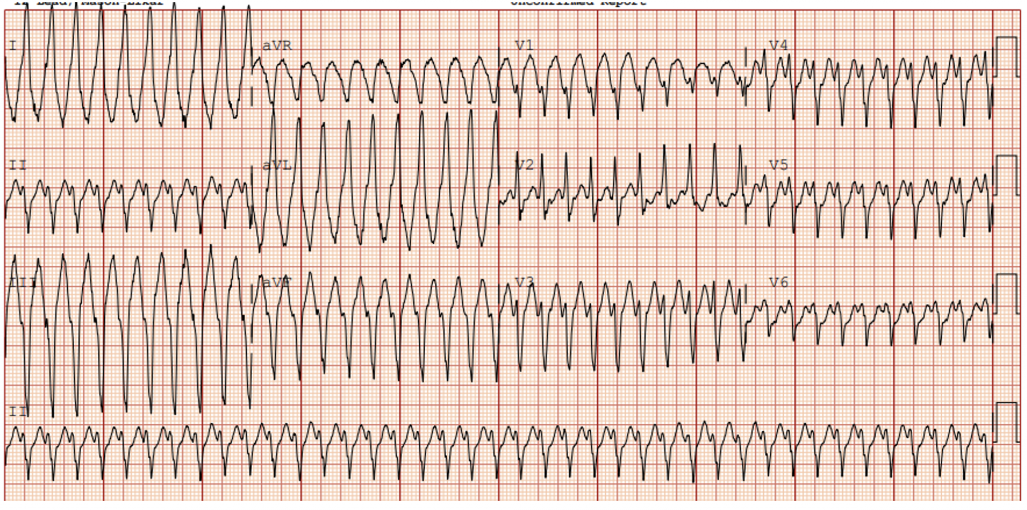 ECG Pointers: WPW doesn't usually cause a problem, right? - emDocs