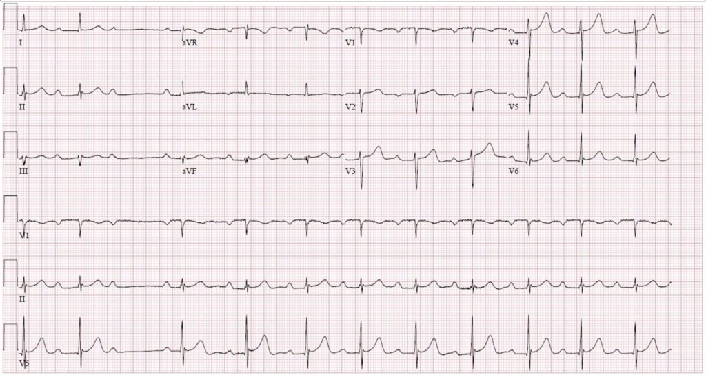 ECG Pointers: Blocks - emDocs