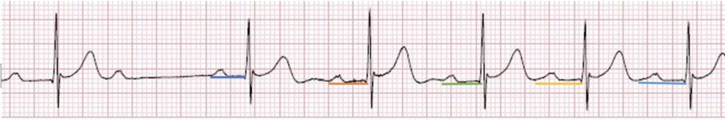 ECG Pointers: Blocks - emDocs