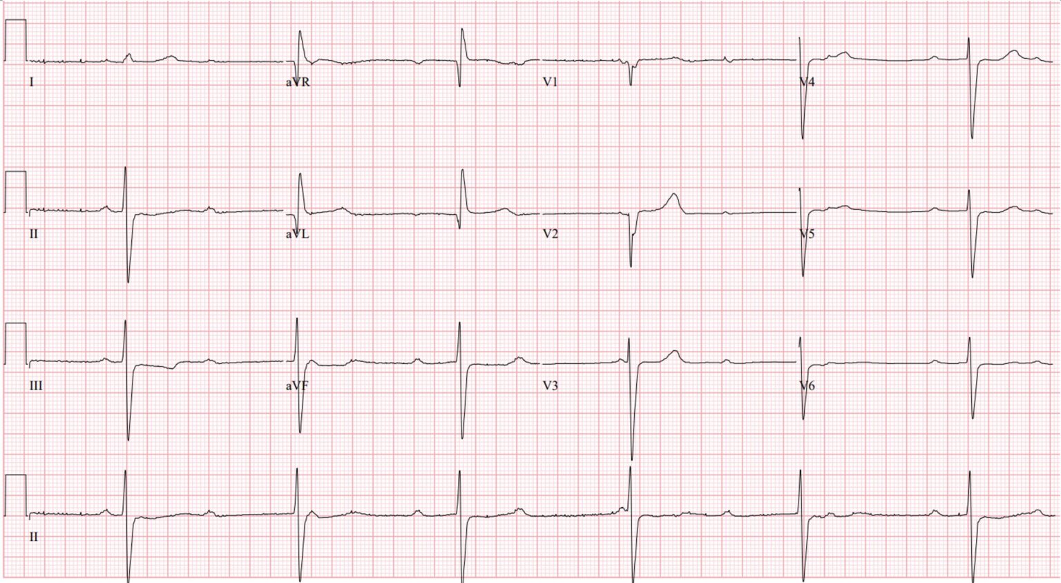ECG Pointers: Blocks - emDocs