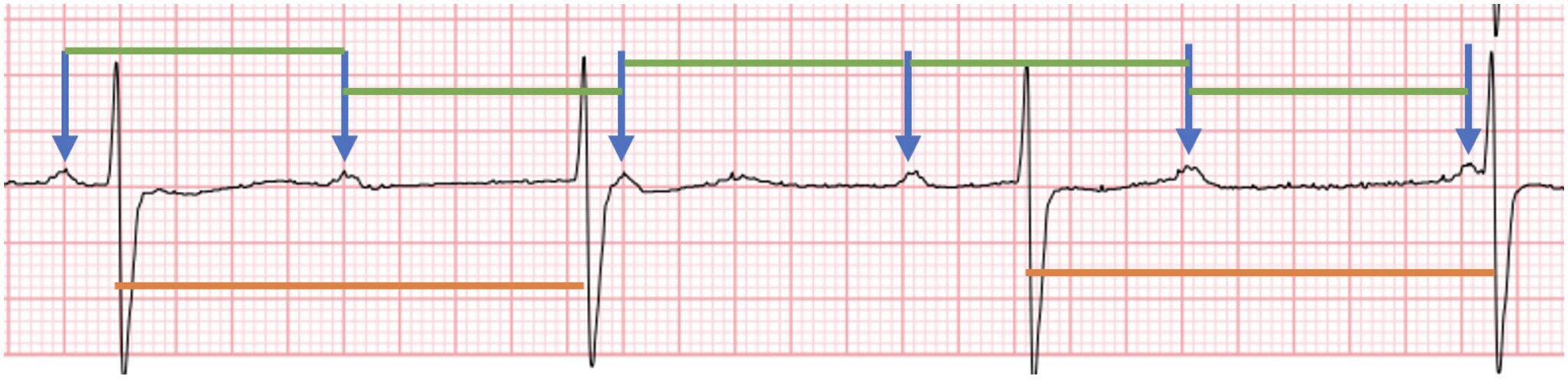 ECG Pointers: Blocks - emDocs