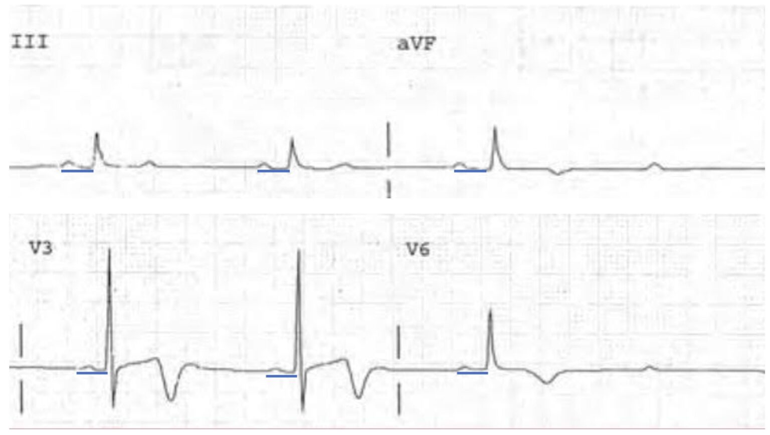 ECG Pointers: Blocks - emDocs