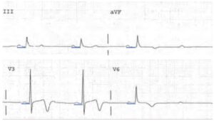 ECG Pointers: Blocks - emDocs