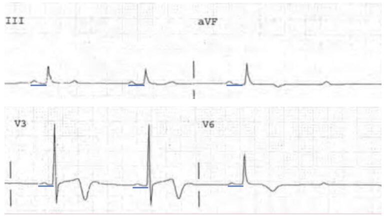ECG Pointers: Blocks - emDocs