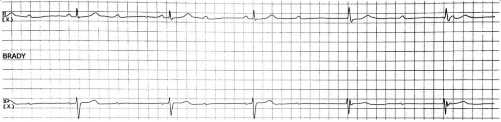 ECG Pointers: Blocks - emDocs