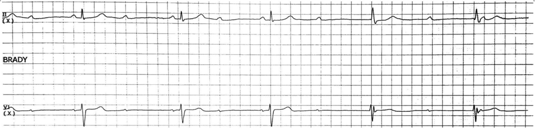 ECG Pointers: Blocks - emDocs