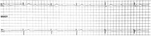 ECG Pointers: Blocks - emDocs