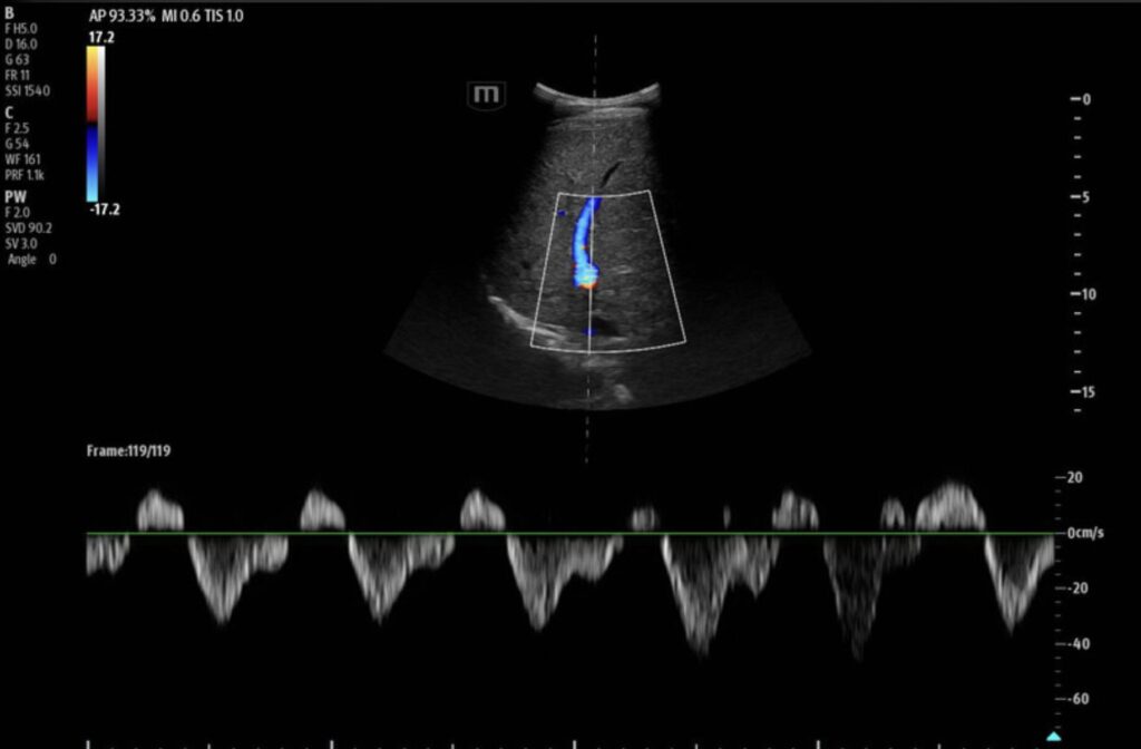 US Probe: Assessing Venous Congestion - The VExUS Approach - emDocs