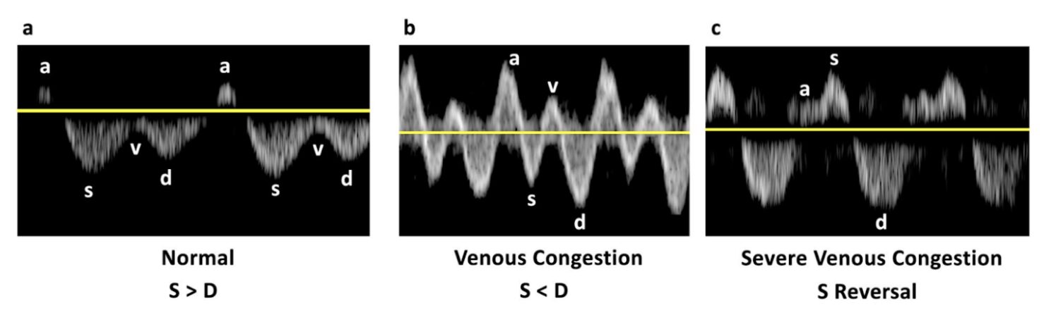 US Probe: Assessing Venous Congestion - The VExUS Approach - emDocs