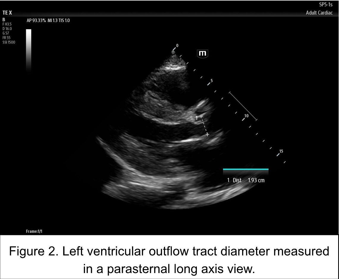 US Probe: Velocity Time Integral (VTI) in Sepsis Management - emDocs