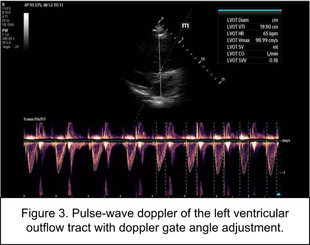 US Probe: Velocity Time Integral (VTI) in Sepsis Management - emDocs