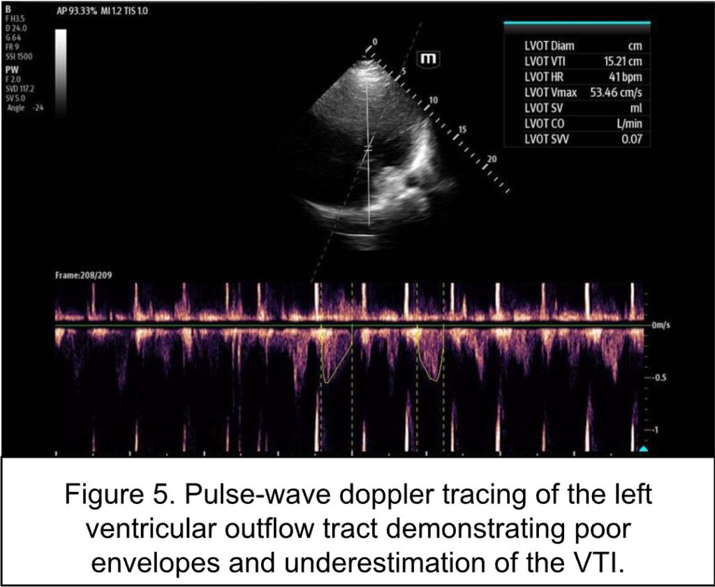 US Probe: Velocity Time Integral (VTI) in Sepsis Management - emDocs