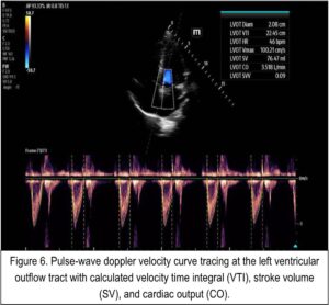 US Probe: Velocity Time Integral (VTI) in Sepsis Management - emDocs
