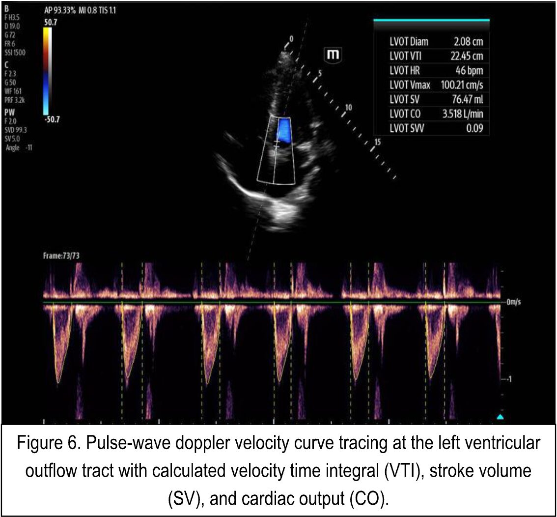 US Probe: Velocity Time Integral (VTI) in Sepsis Management - emDocs