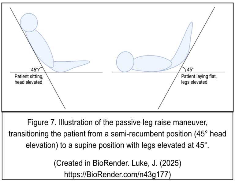 US Probe: Velocity Time Integral (VTI) in Sepsis Management - emDocs
