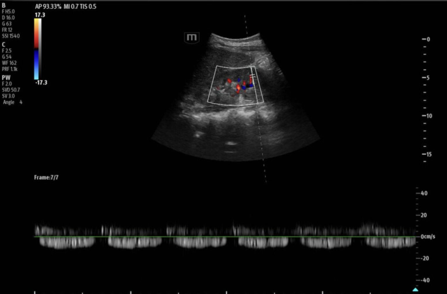 US Probe: Assessing Venous Congestion - The VExUS Approach - emDocs