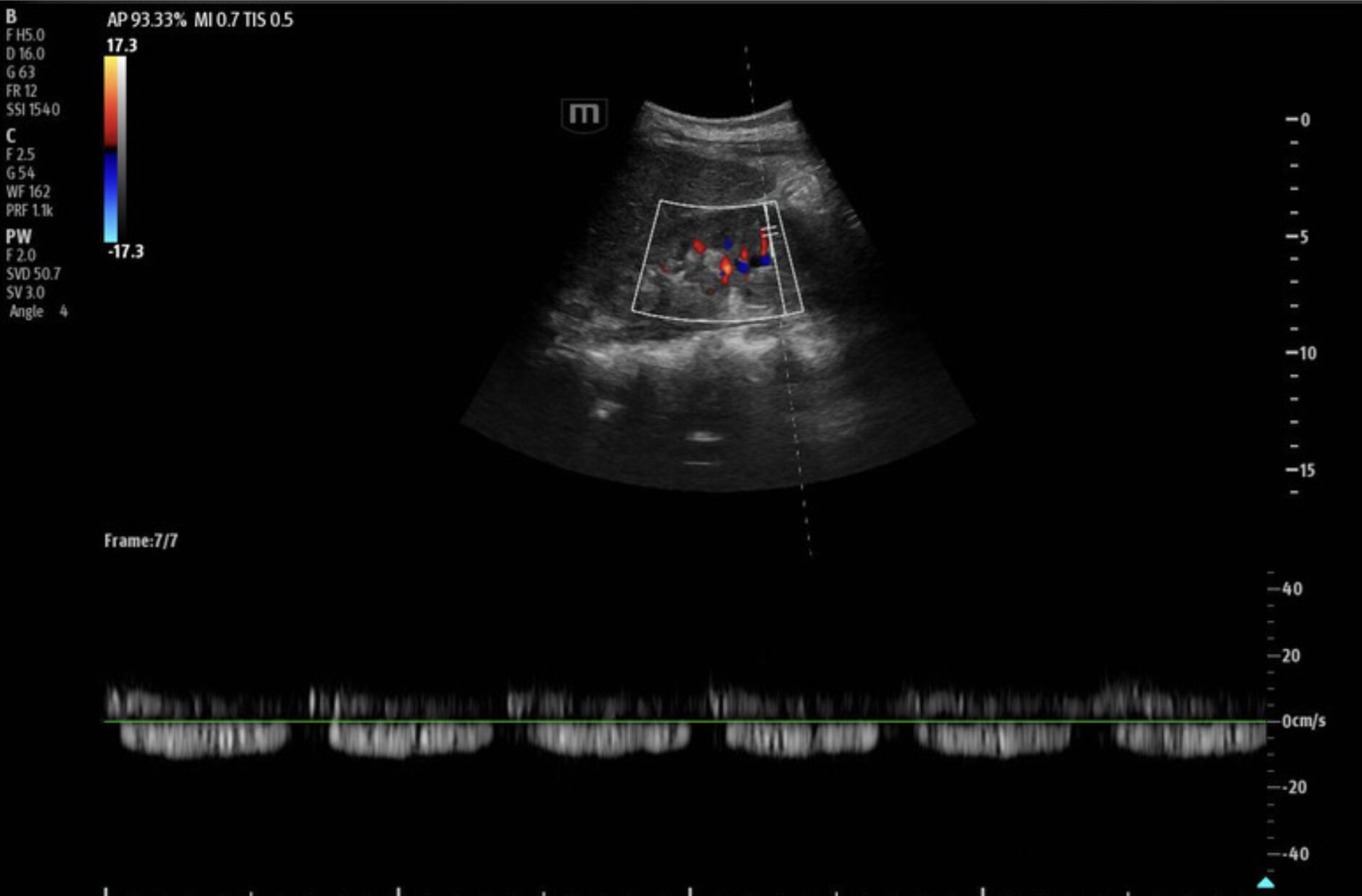 US Probe: Assessing Venous Congestion - The VExUS Approach - emDocs