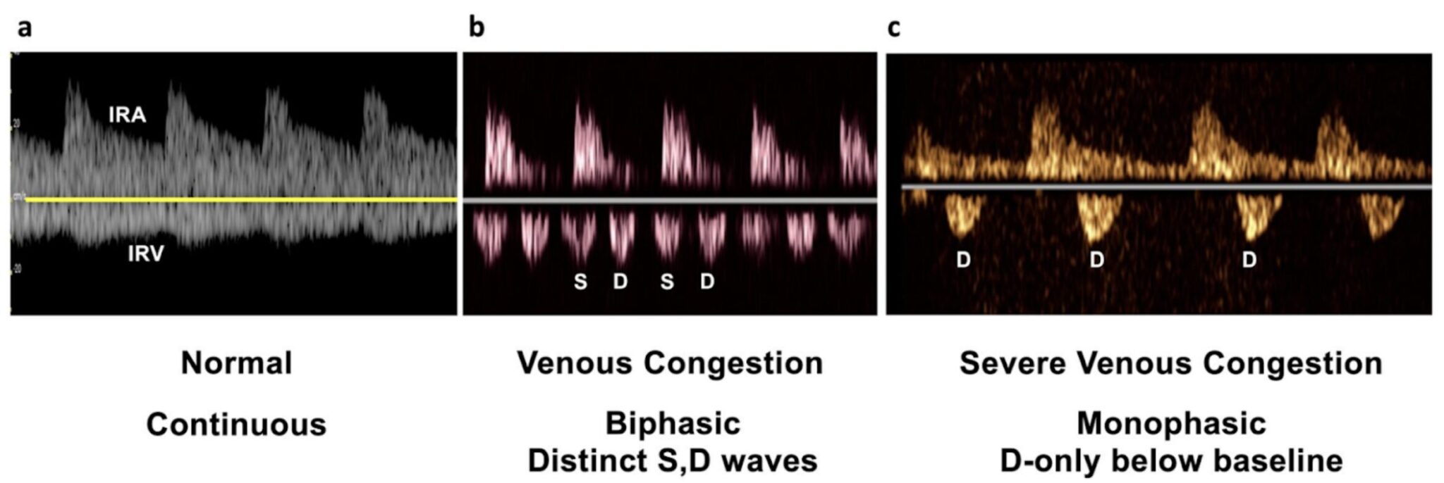 US Probe: Assessing Venous Congestion - The VExUS Approach - emDocs
