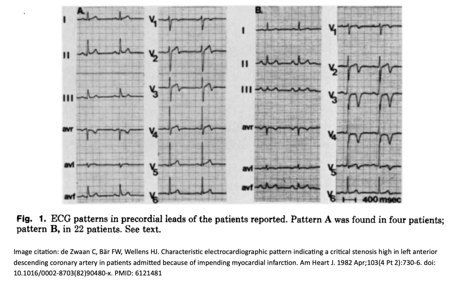 ECG Pointers: Pain Free but Not Worry Free - emDocs
