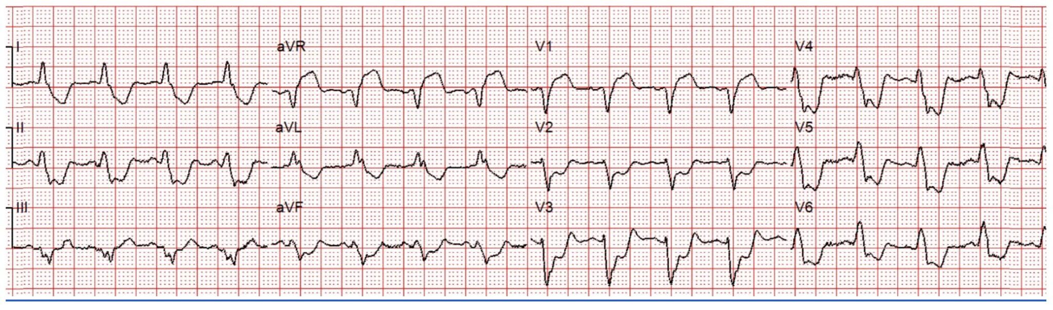 ECG Pointers: Sgarbossing it up! - emDocs