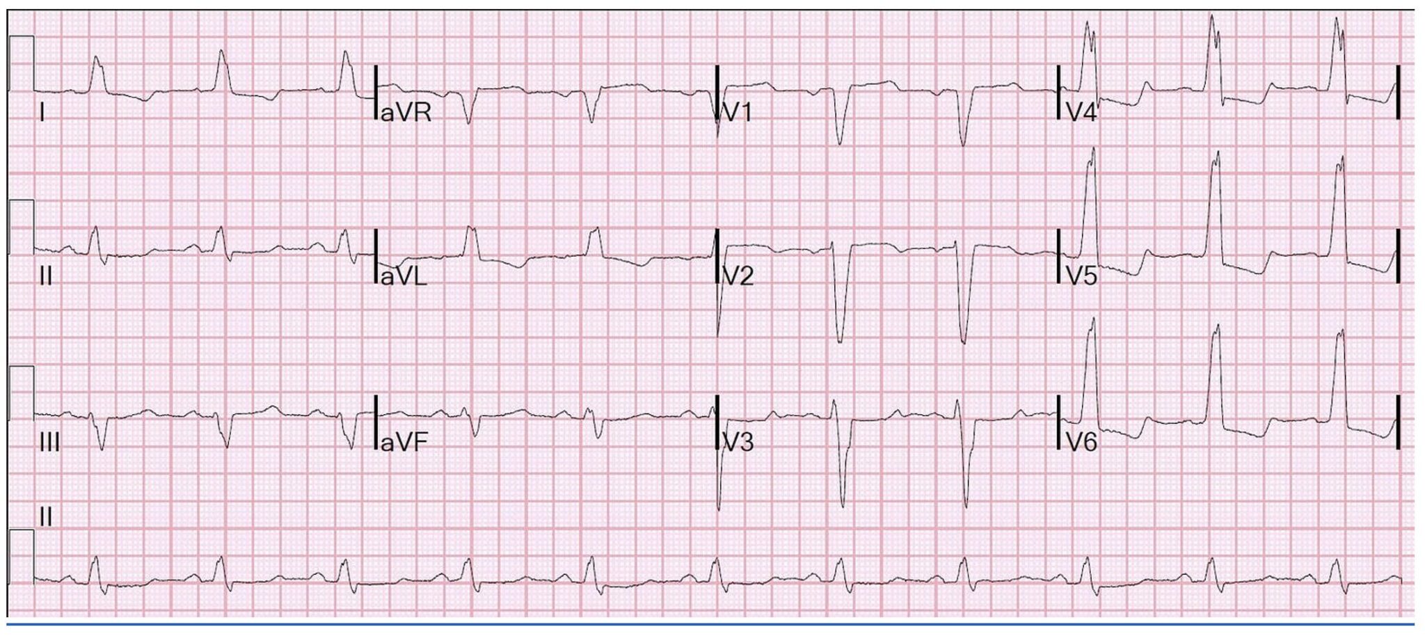 ECG Pointers: Sgarbossing it up! - emDocs