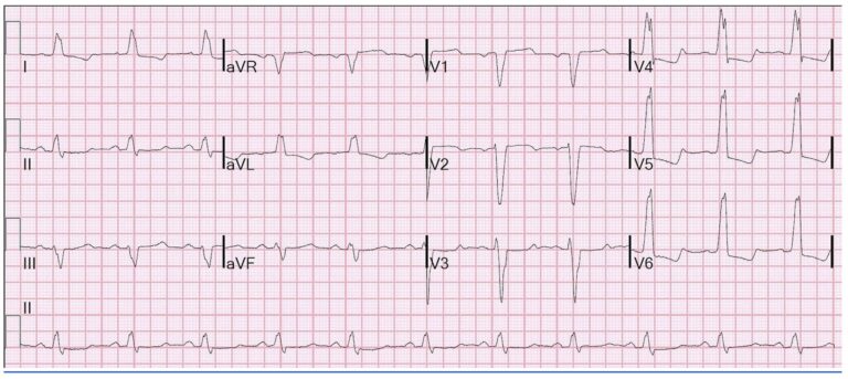 ECG Pointers: Sgarbossing it up! - emDocs
