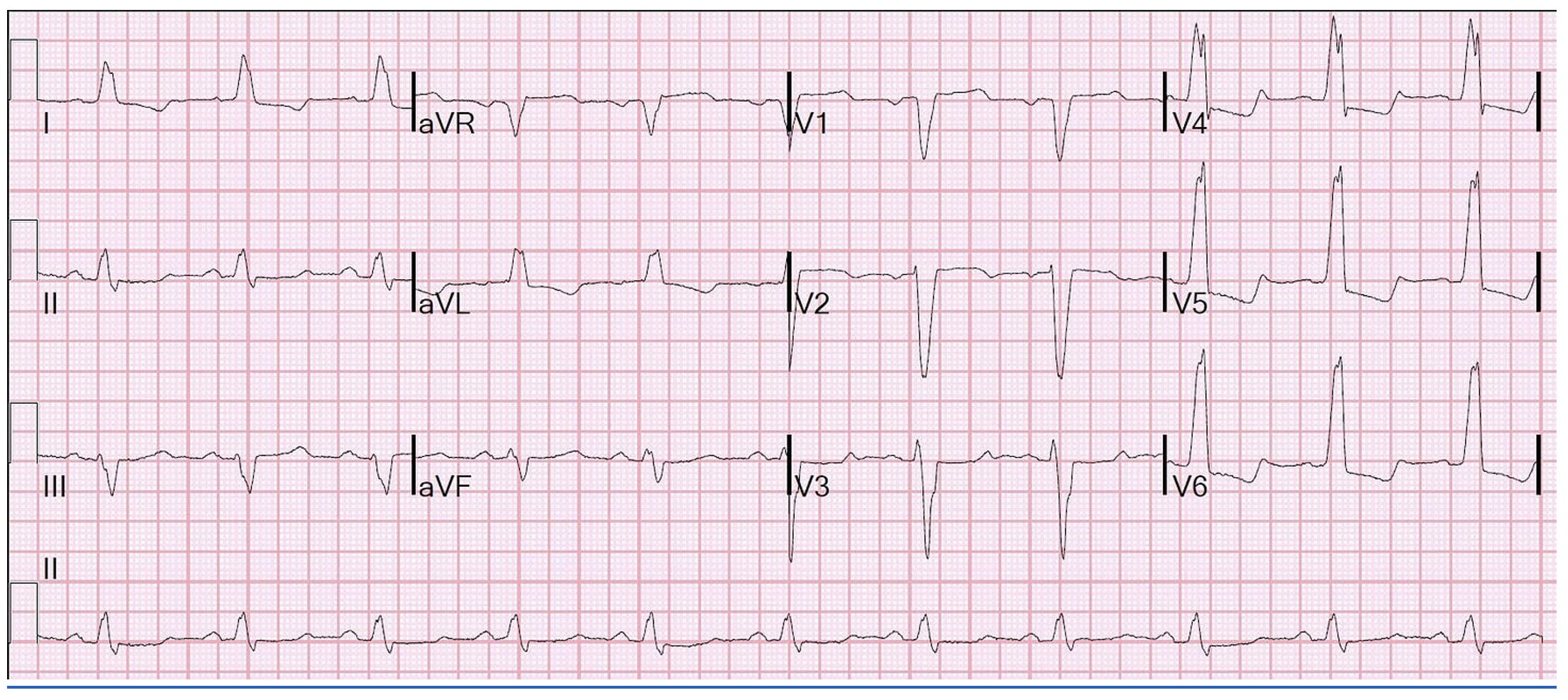 ECG Pointers: Sgarbossing it up! - emDocs