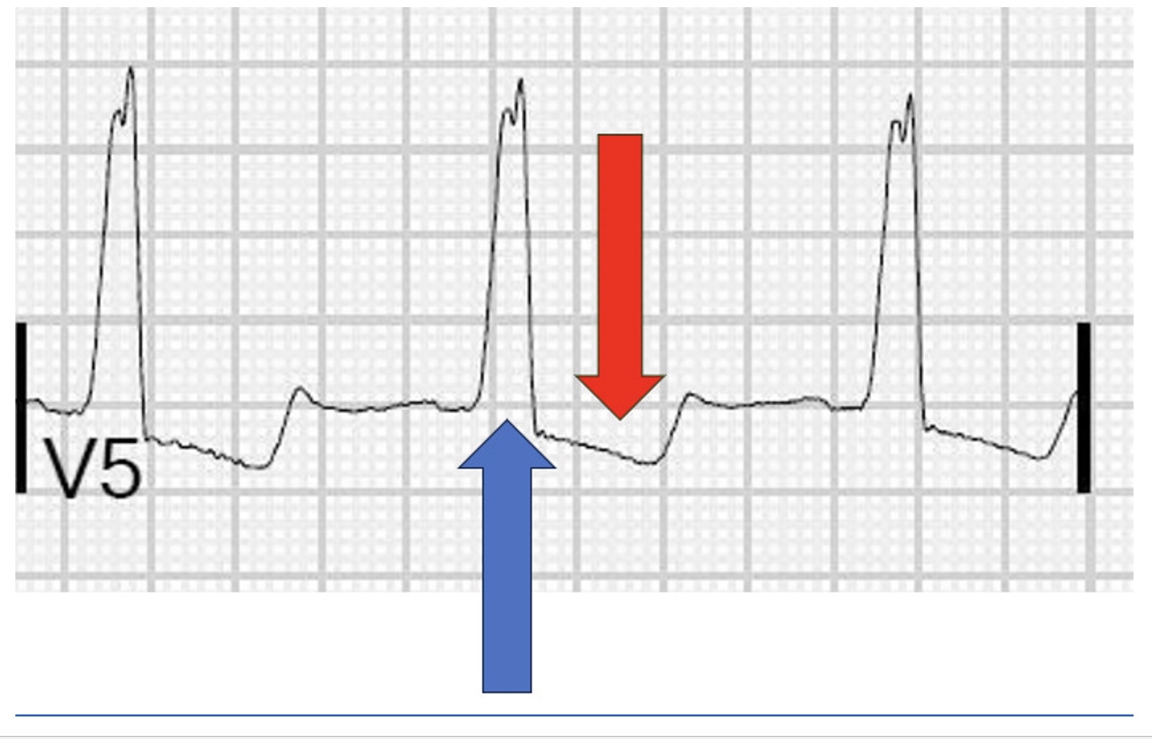 ECG Pointers: Sgarbossing it up! - emDocs