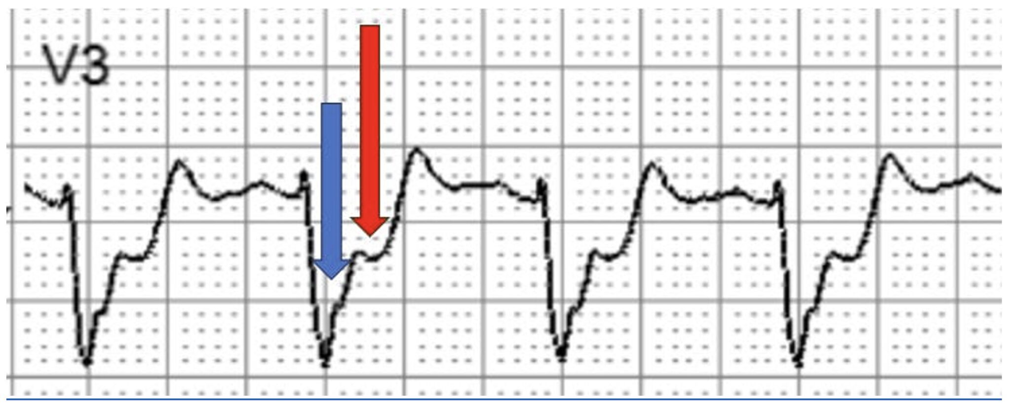 ECG Pointers: Sgarbossing it up! - emDocs