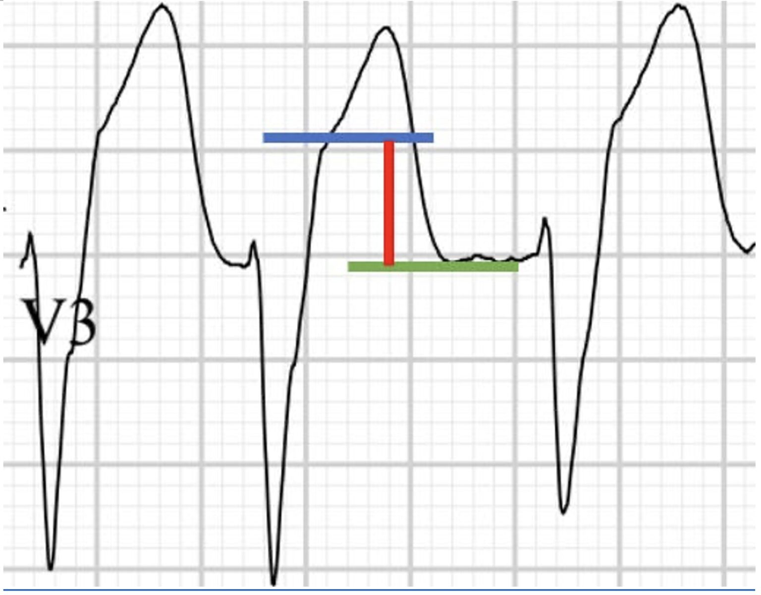 ECG Pointers: Sgarbossing it up! - emDocs
