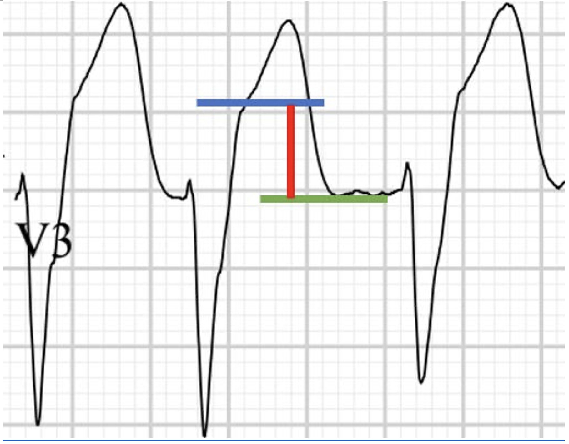 ECG Pointers: Sgarbossing it up! - emDocs