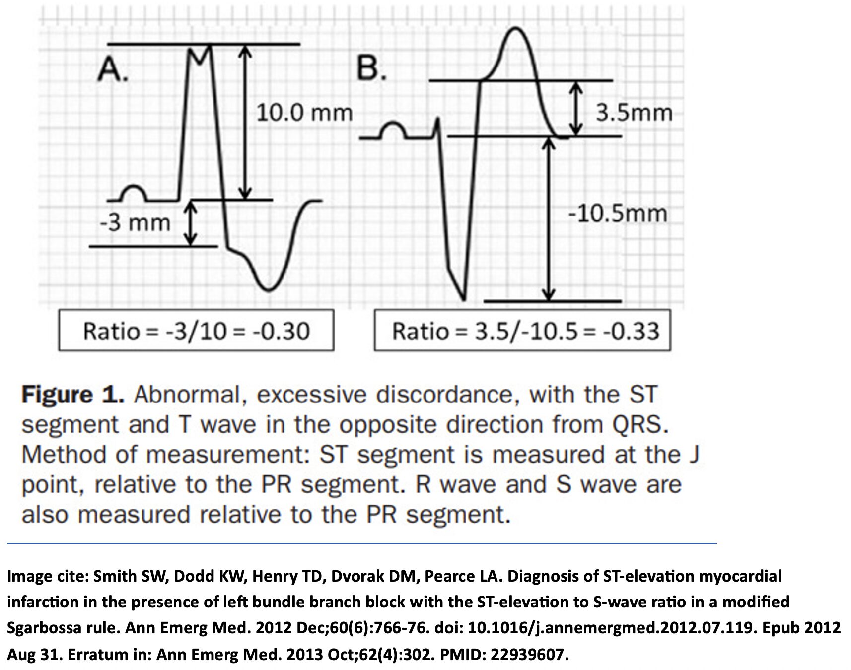 ECG Pointers: Sgarbossing it up! - emDocs