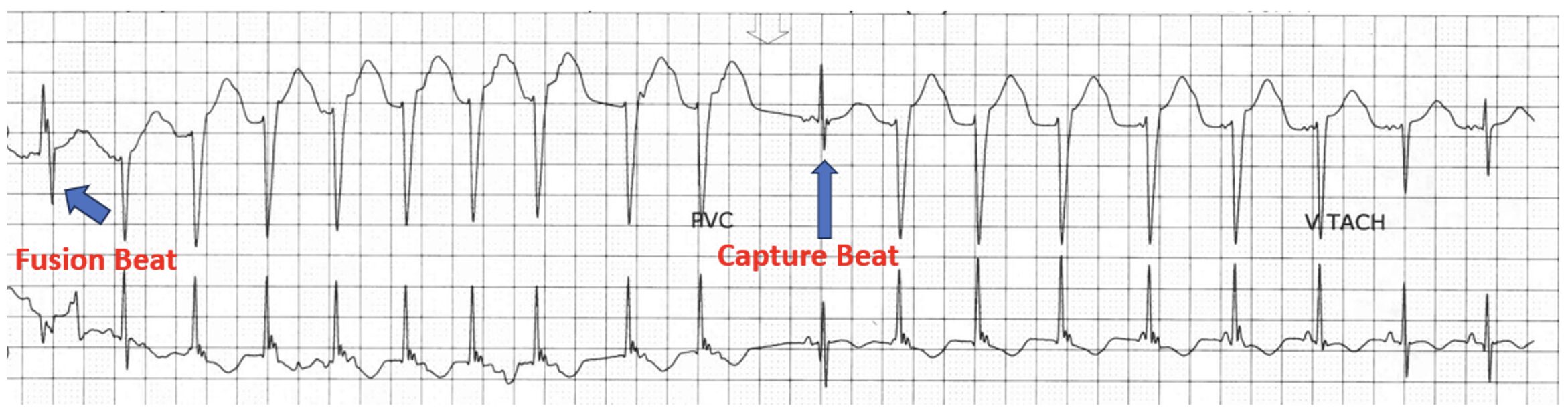 ECG Pointers: Having hard conversations causes … Vtach? - emDocs
