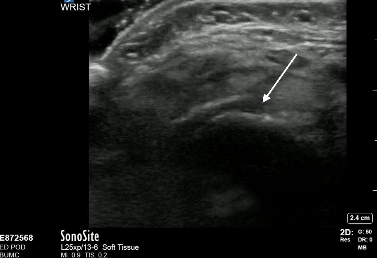 US Probe: POCUS for the Diagnosis of Acute Pediatric Distal Radius ...