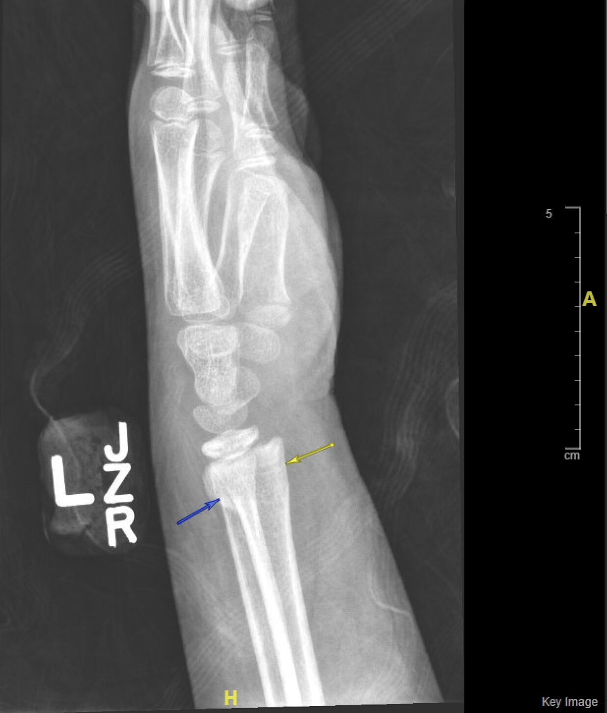 US Probe: POCUS for the Diagnosis of Acute Pediatric Distal Radius ...