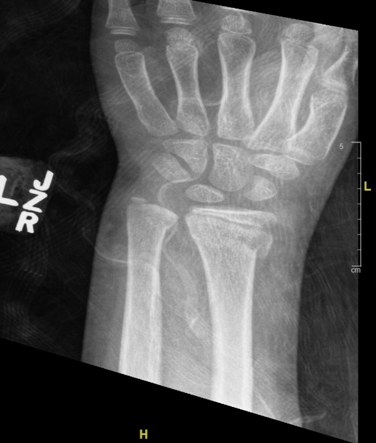 US Probe: POCUS for the Diagnosis of Acute Pediatric Distal Radius ...
