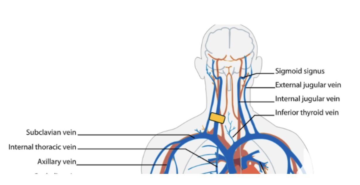 US Probe: Upper Extremity DVT - emDocs