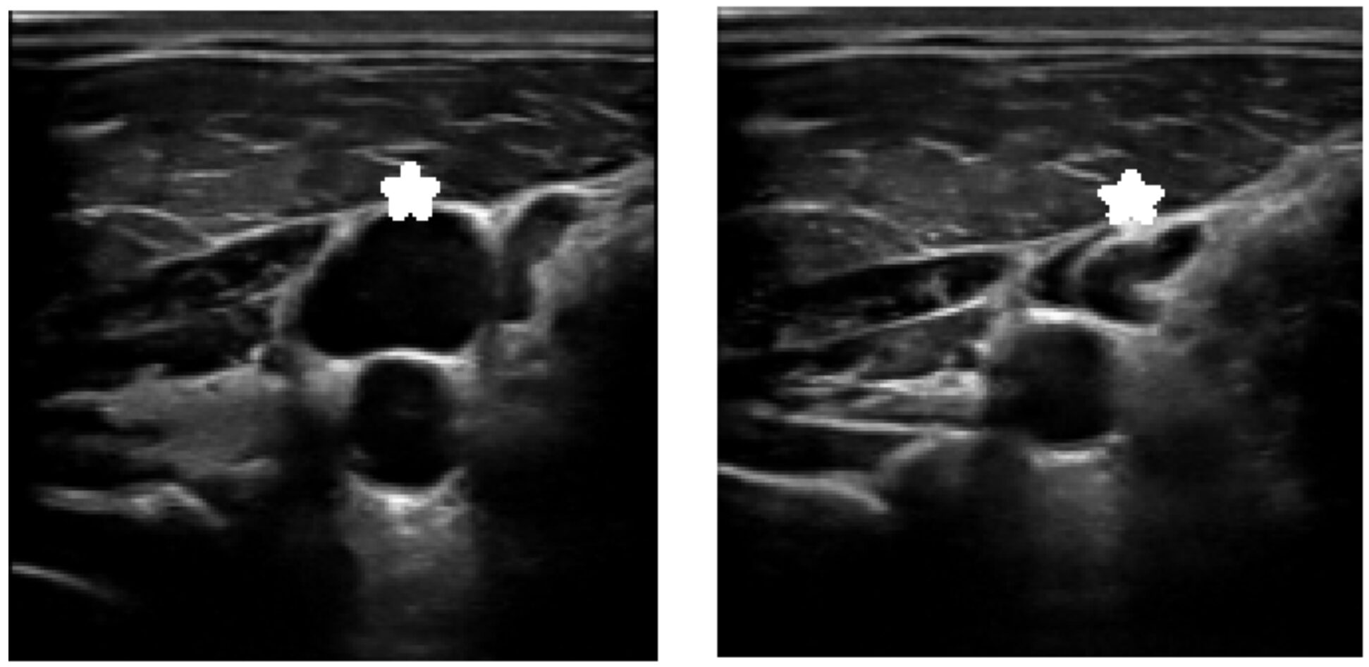 US Probe: Upper Extremity DVT - emDocs