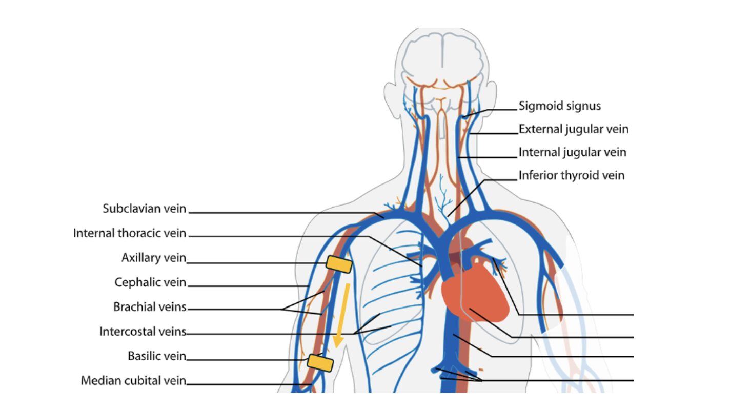 US Probe: Upper Extremity DVT - emDocs
