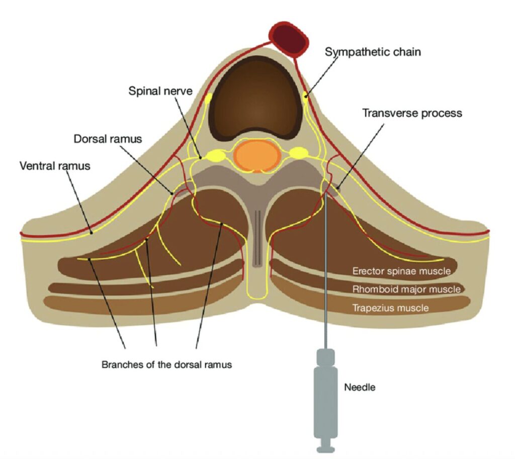 Ultrasound Guided Erector Spinae Plane Block - emDocs