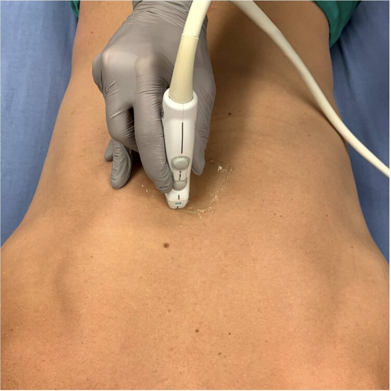 Ultrasound Guided Erector Spinae Plane Block - emDocs