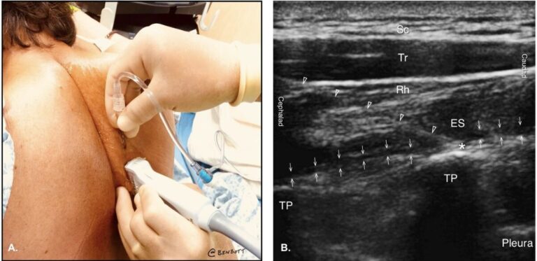 Ultrasound Guided Erector Spinae Plane Block - emDocs