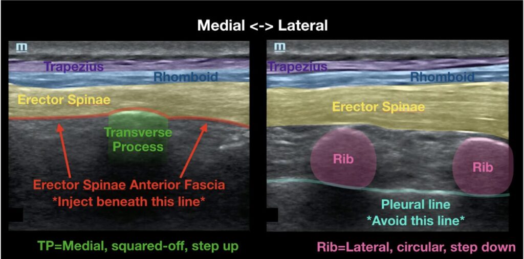Ultrasound Guided Erector Spinae Plane Block - emDocs
