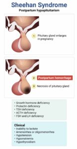 EM@3AM: Panhypopituitarism - emDocs