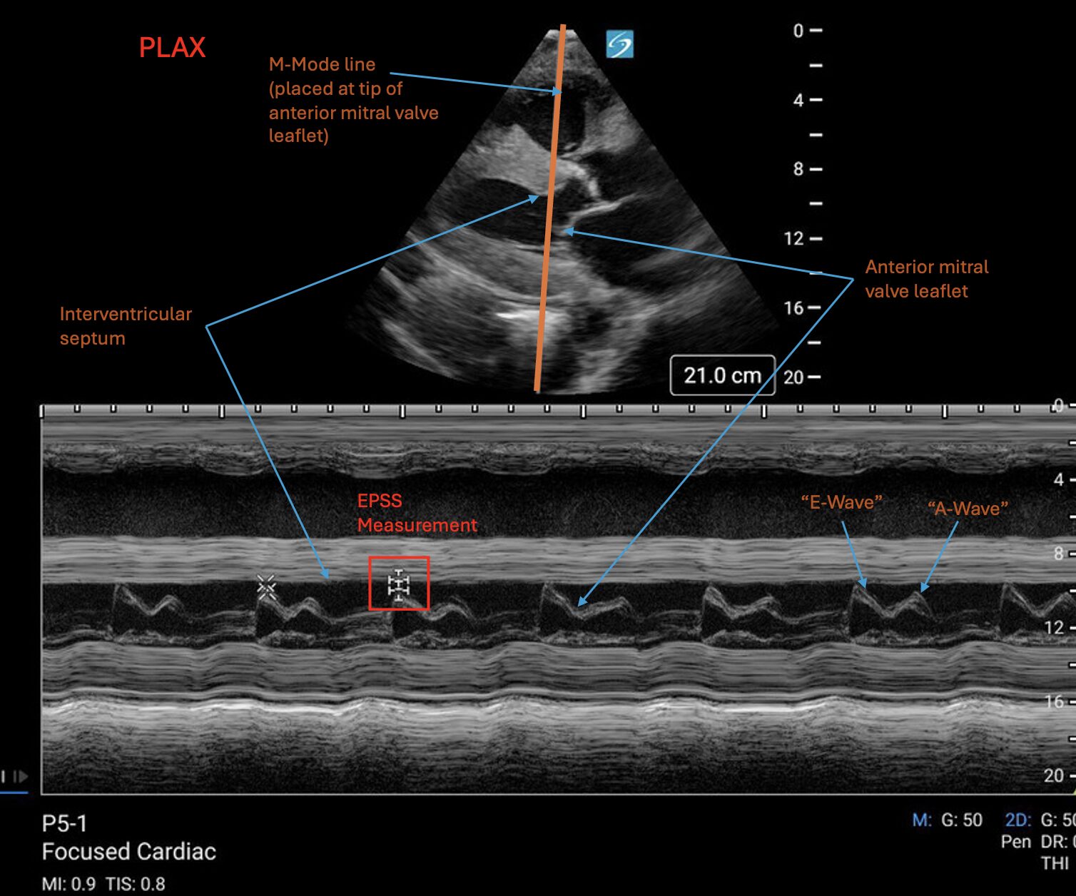 US Probe: Left Ventricular Ejection Fraction Semi-Quantitative ...