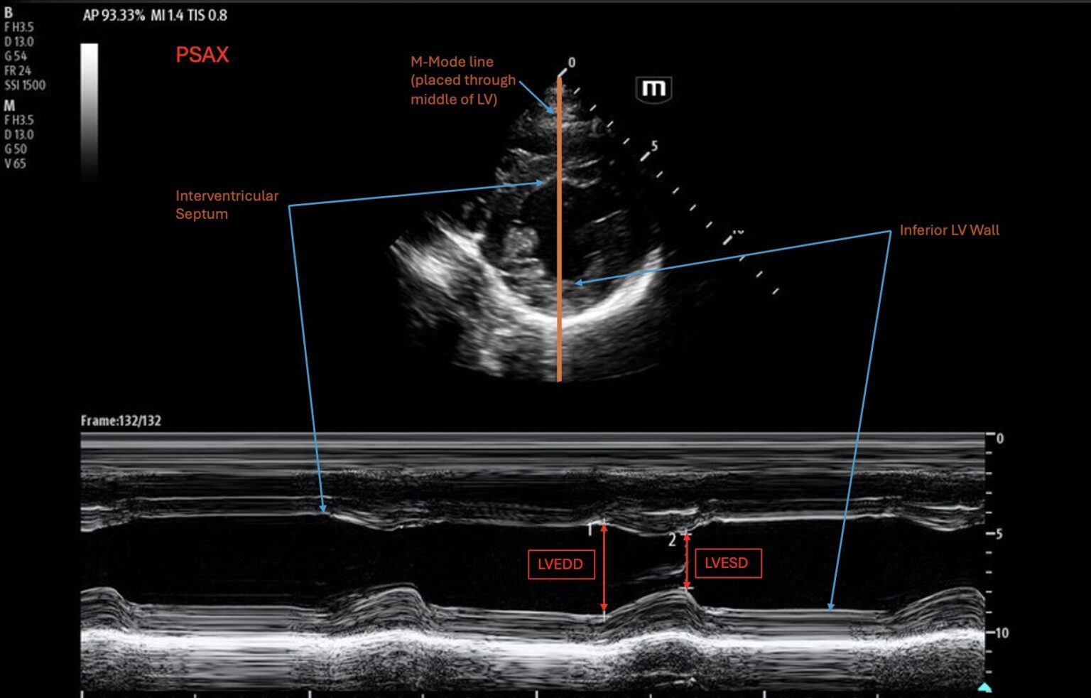 US Probe: Left Ventricular Ejection Fraction Semi-Quantitative ...
