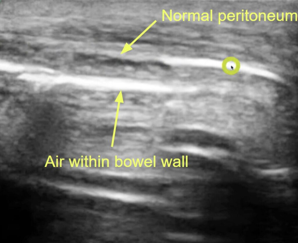 EM@3AM: Perforated Viscus - emDocs