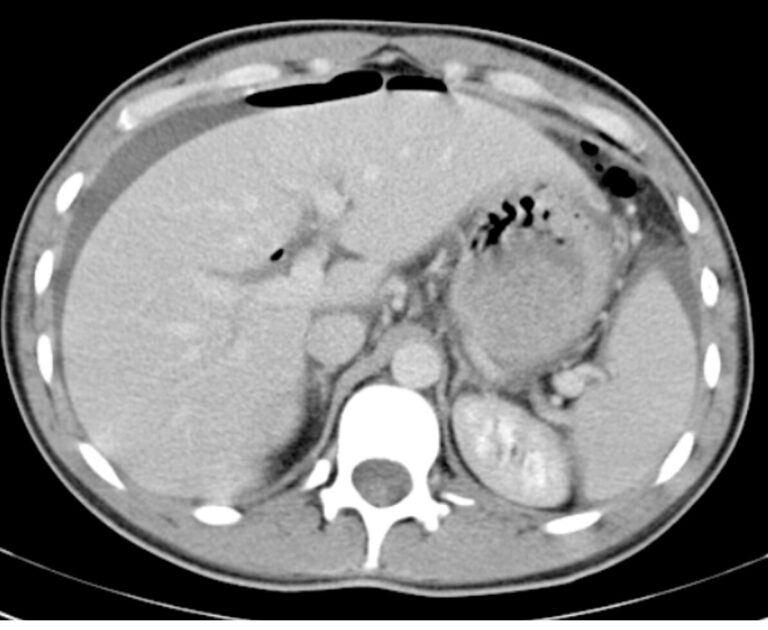 EM@3AM: Perforated Viscus - emDocs