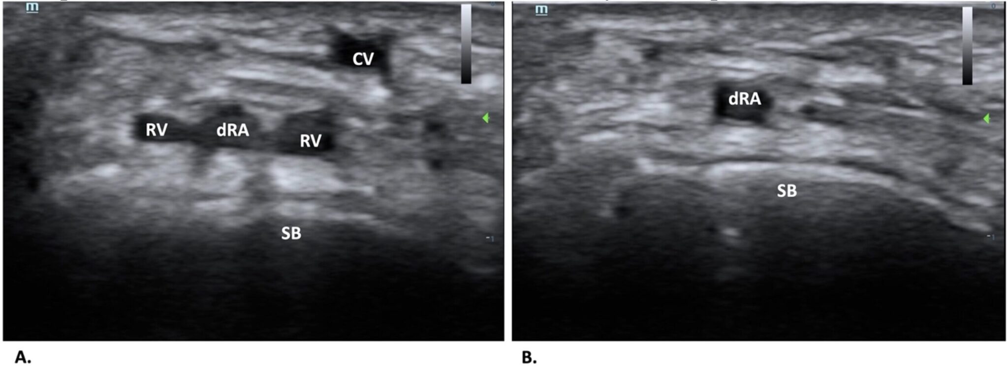 Snuff said: anatomical snuffbox distal radial arterial lines for the ...