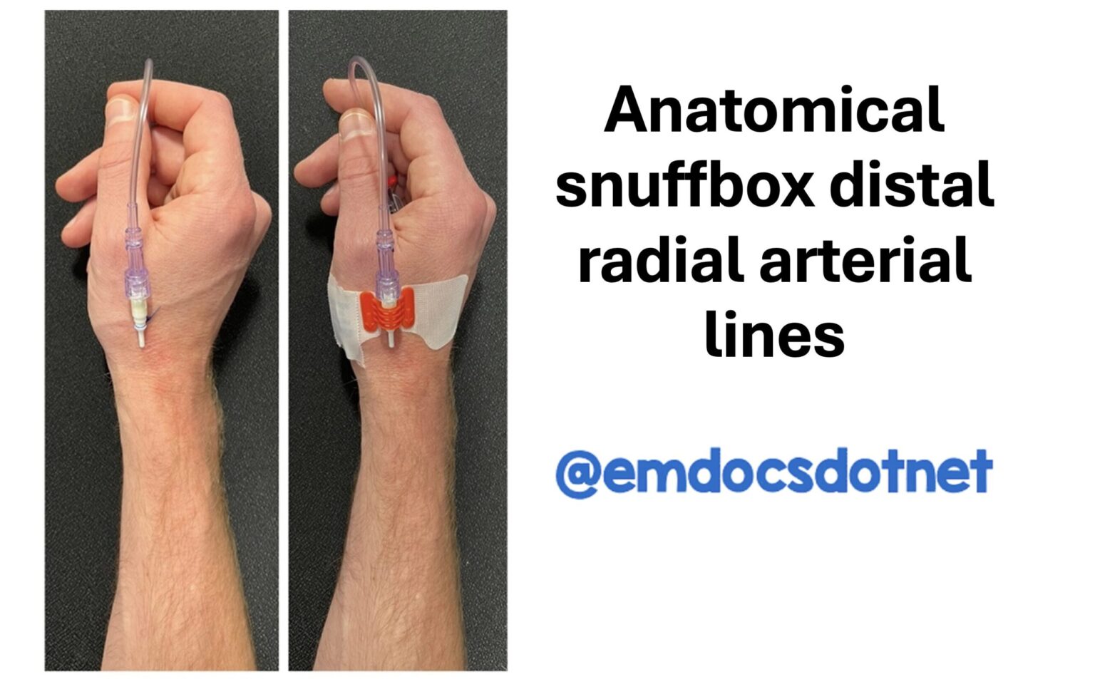 Snuff said: anatomical snuffbox distal radial arterial lines for the ...